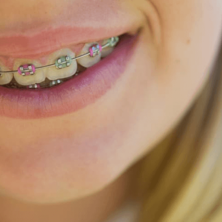 Braces Colors That Look Good Together What Braces Colors Are